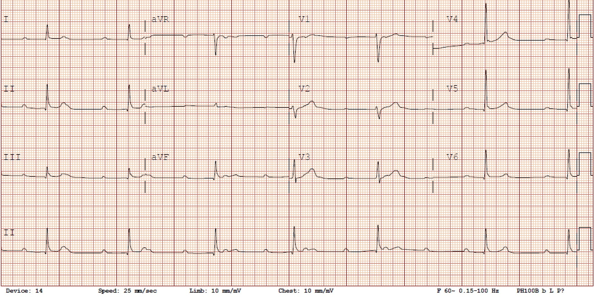 Third-degree heart block secondary to Lyme carditis | British Columbia ...