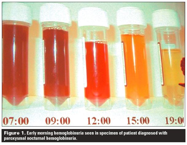 Paroxysmal nocturnal hemoglobinuria: Recommendations for diagnostic ...
