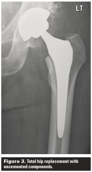Total hip replacement: Relieving pain and restoring function | British ...