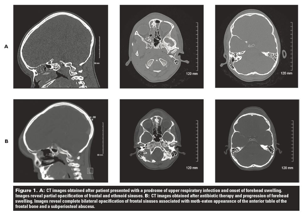 Forehead swelling in a 10-year-old male: A case report | British ...